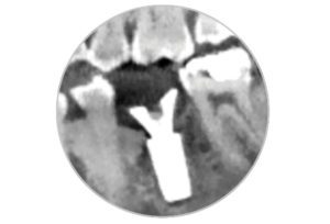 Custom Tissue Former - Dental Crafters